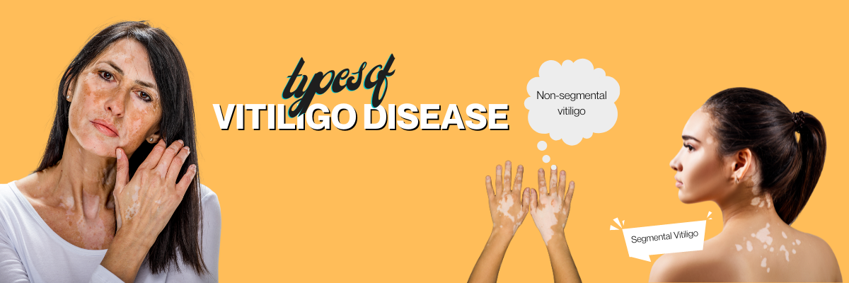 Vitiligo Skin Treatment - Dr. Kasana's Clinic